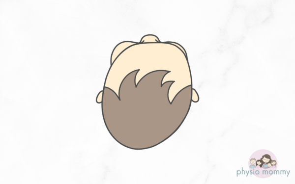 Flat Head Syndrome - Physiomommy